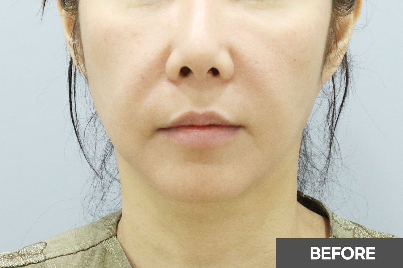 Main lifting - 플래닛성형외과